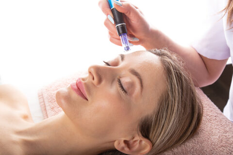Microneedling: Werkt het echt voor acne littekens en huidveroudering?